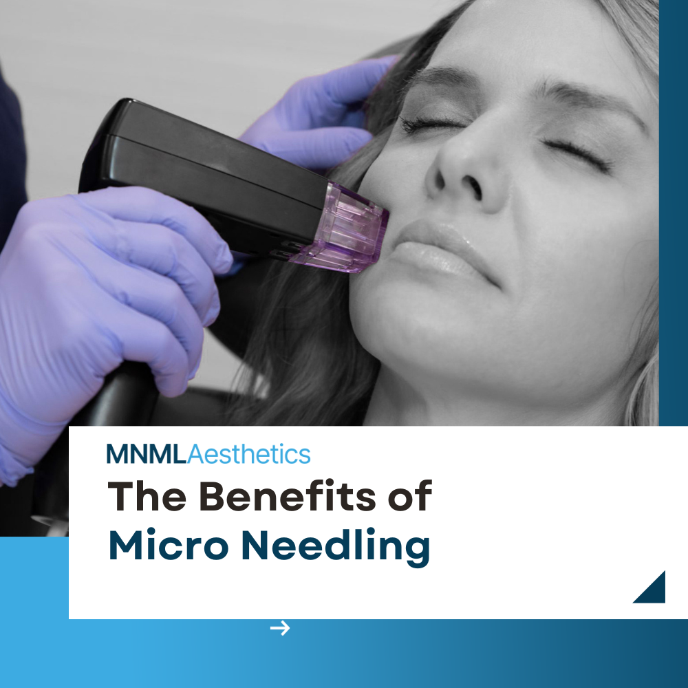 Benefits of Micro-needling – MNML Aesthetics